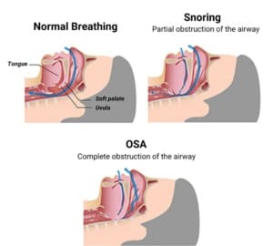 What is Obstructive Sleep Apnea (OSA)? | Apnée Santé